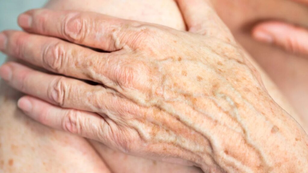 Effective Solutions for Dark Spots on Your Hands: Restore Your Skin's ...